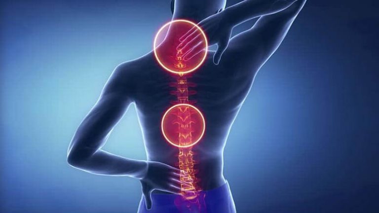 Κύφωση: Συμπτώματα και Επιπλοκές | Doctoranytime blog