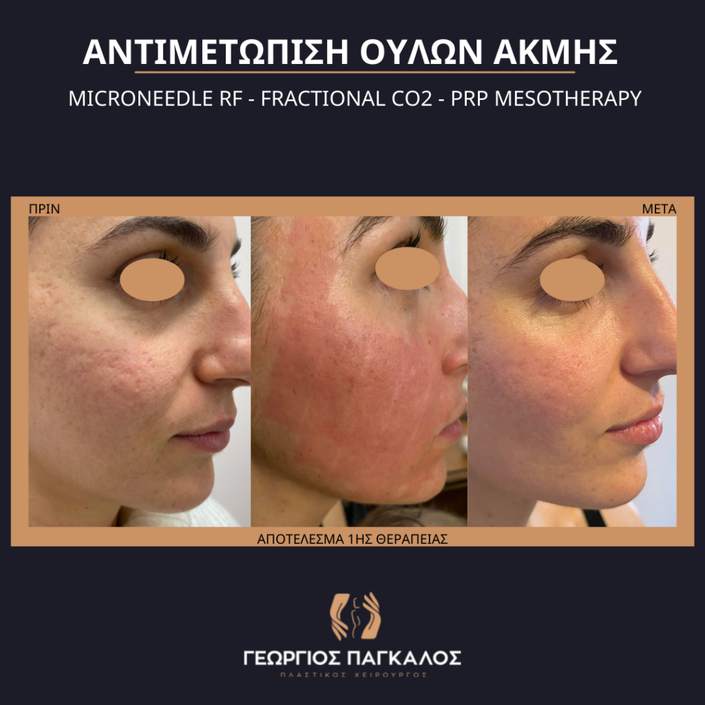 Fractional Rf Microneedling: Θεραπεία προσώπου & Αποτελέσματα